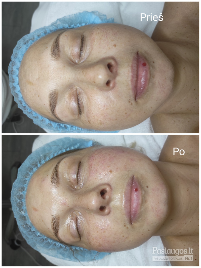 Veido valymas, veido ir kūno masažai, depiliacijos - Klaipėda / Liana ...